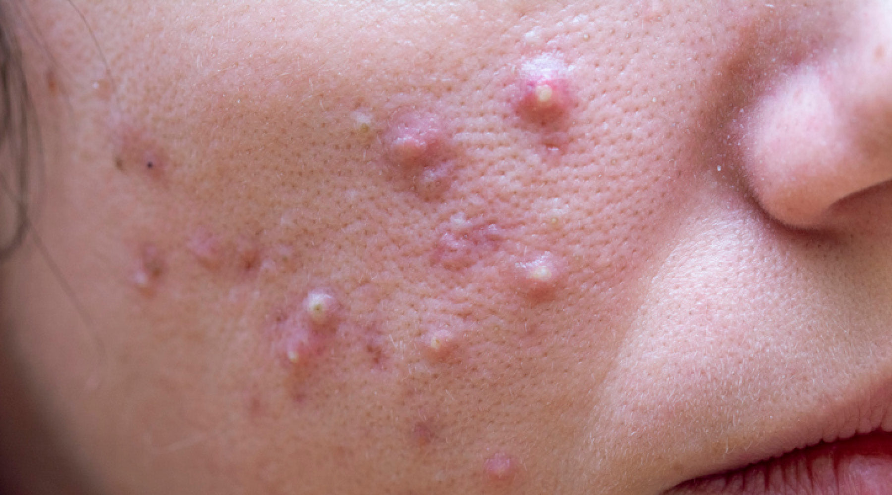 Breaking the Cycle: Effective Strategies for Cystic Acne in Women Over