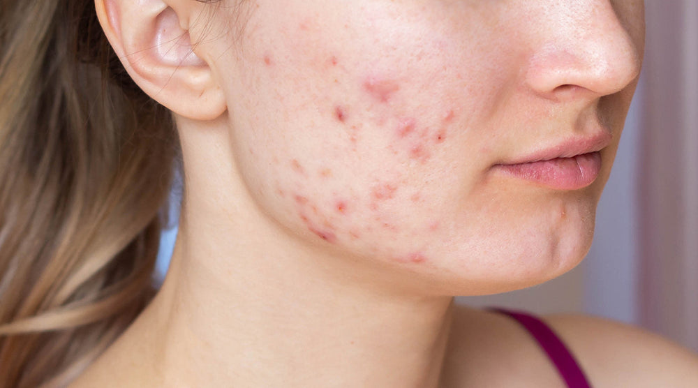 Why Your Skin Gets Worse Before It Gets Better: The Science of Acne Pu