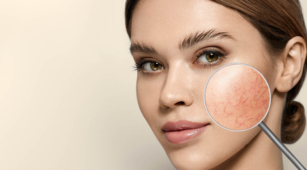 What’s Actually Going On in Your Skin When It Flares? – Roccoco Botanicals