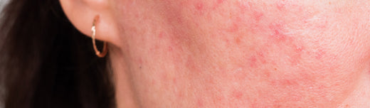Decoding Facial Skin Redness: Causes & Conditions | Roccoco